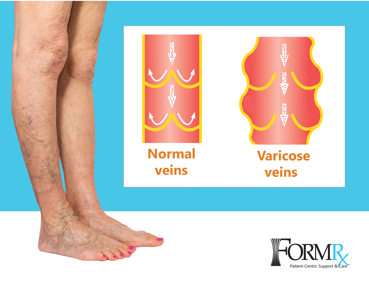 Varicose Veins Comfort Compression Garments – Form RX